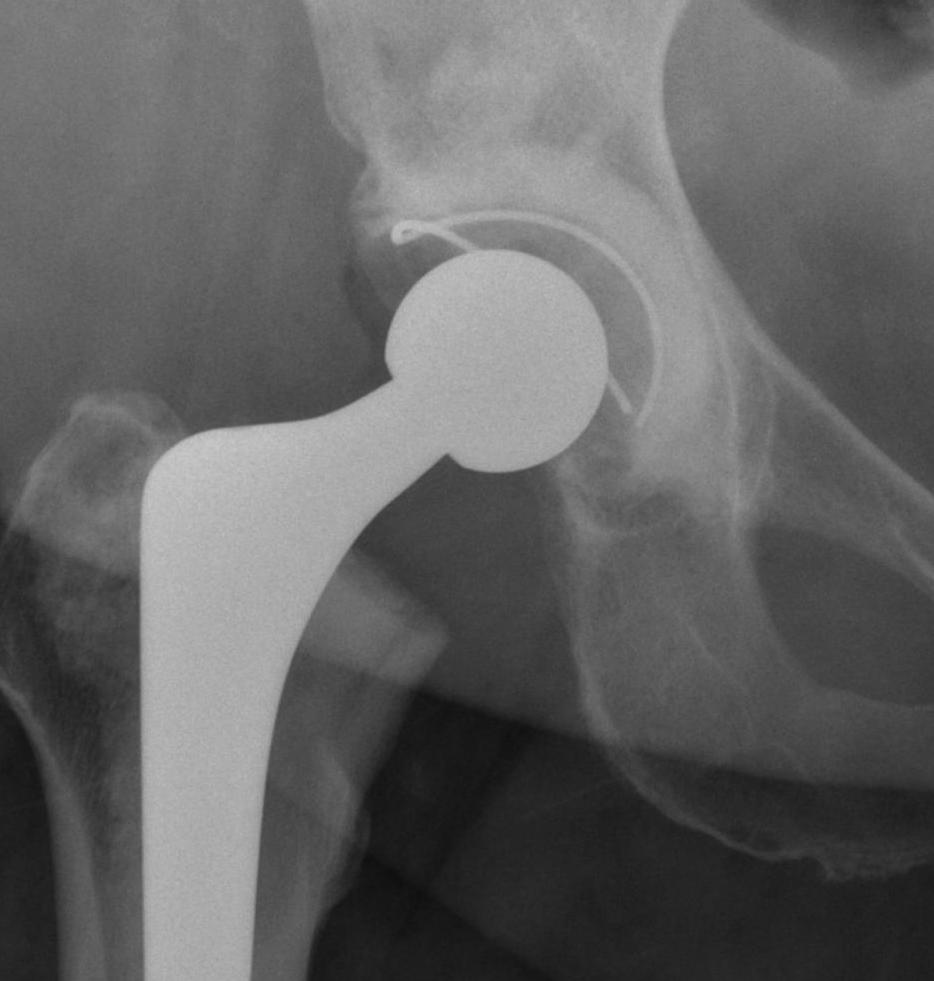 Cemented acetabulum | The Bone School